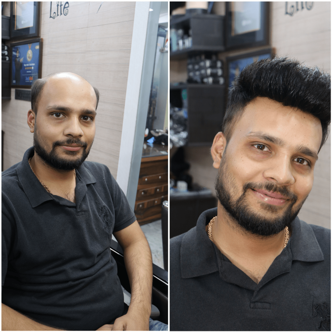 Hair Bonding-Veda Hair fixing Hubli Best Service in Karnataka